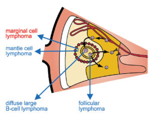 NHL-Subtypes - Lymphoma Canada